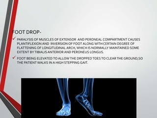 Foot drop | PPT