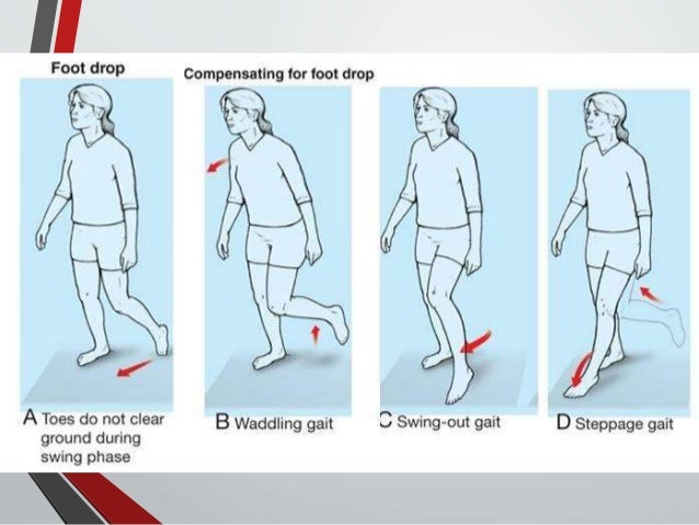 Foot drop