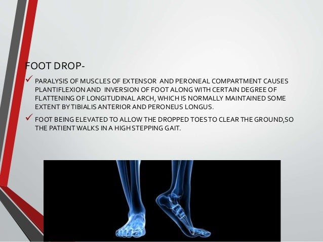 Foot drop