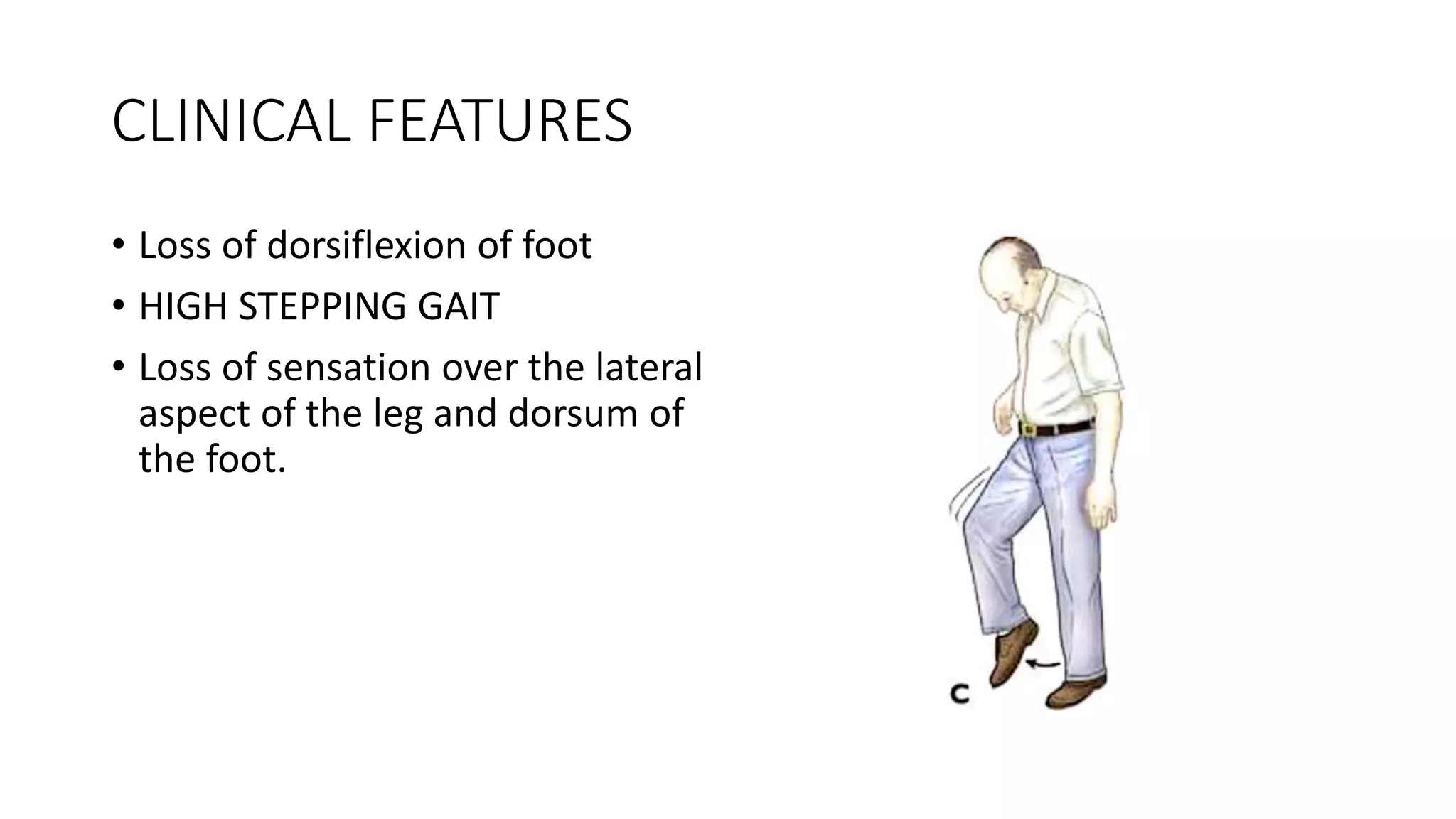 Foot drop | PPTX