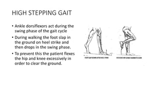 Foot drop | PPTX