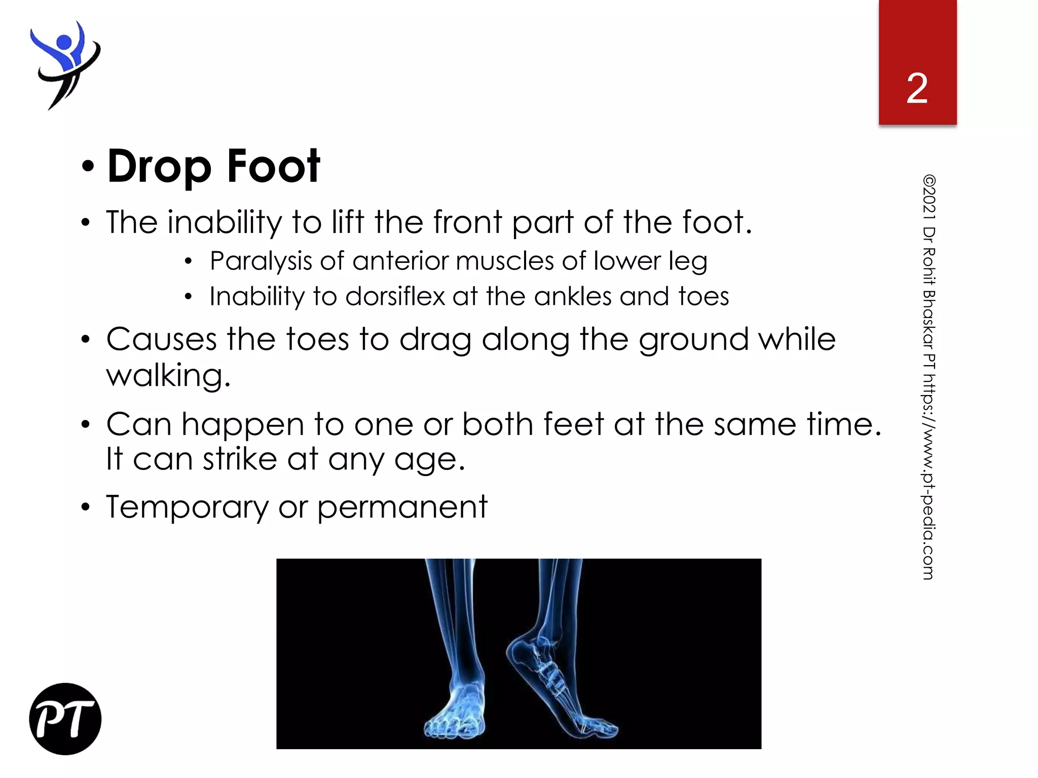 Foot Drop: Causes, Symptoms, and Treatment - Dr Rohit Bhaskar | PDF