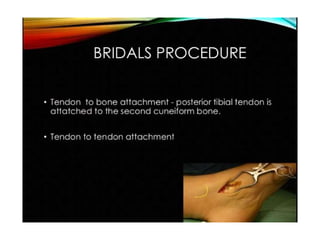 An approach to Foot drop | PPT