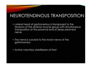 An approach to Foot drop | PPT