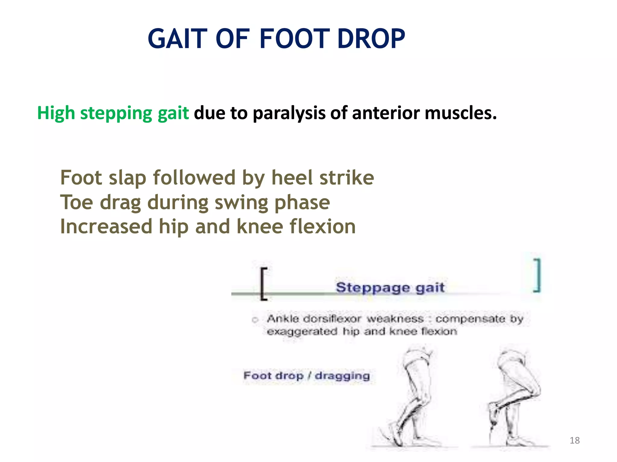 Foot drop | PPTX