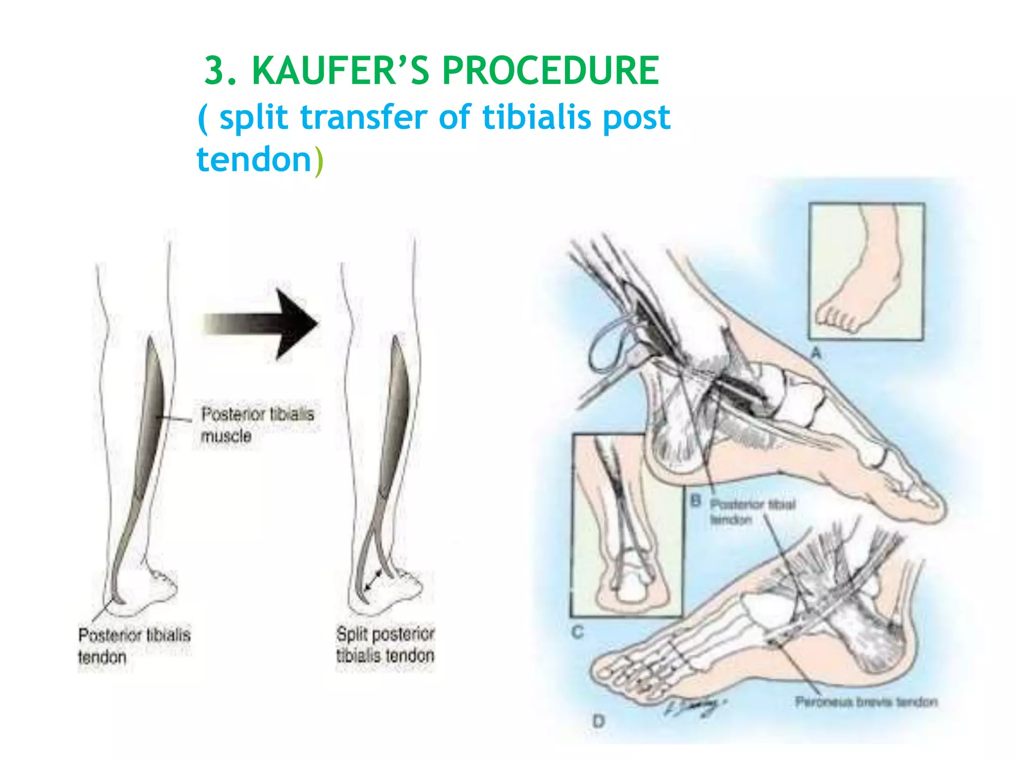 Foot drop | PPTX