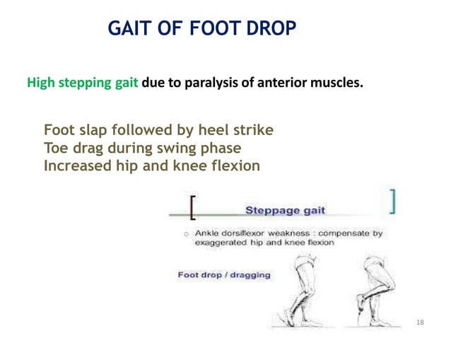 Foot drop | PPTX | Death, Injury, or Military Conflict | Sensitive Topics