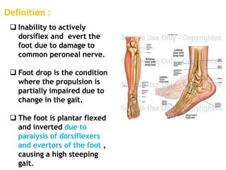Peroneal Nerve Foot Drop
