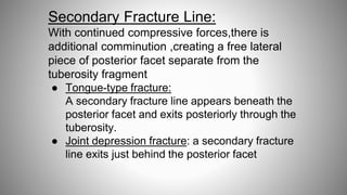 FOOT FRACTURE.pptx