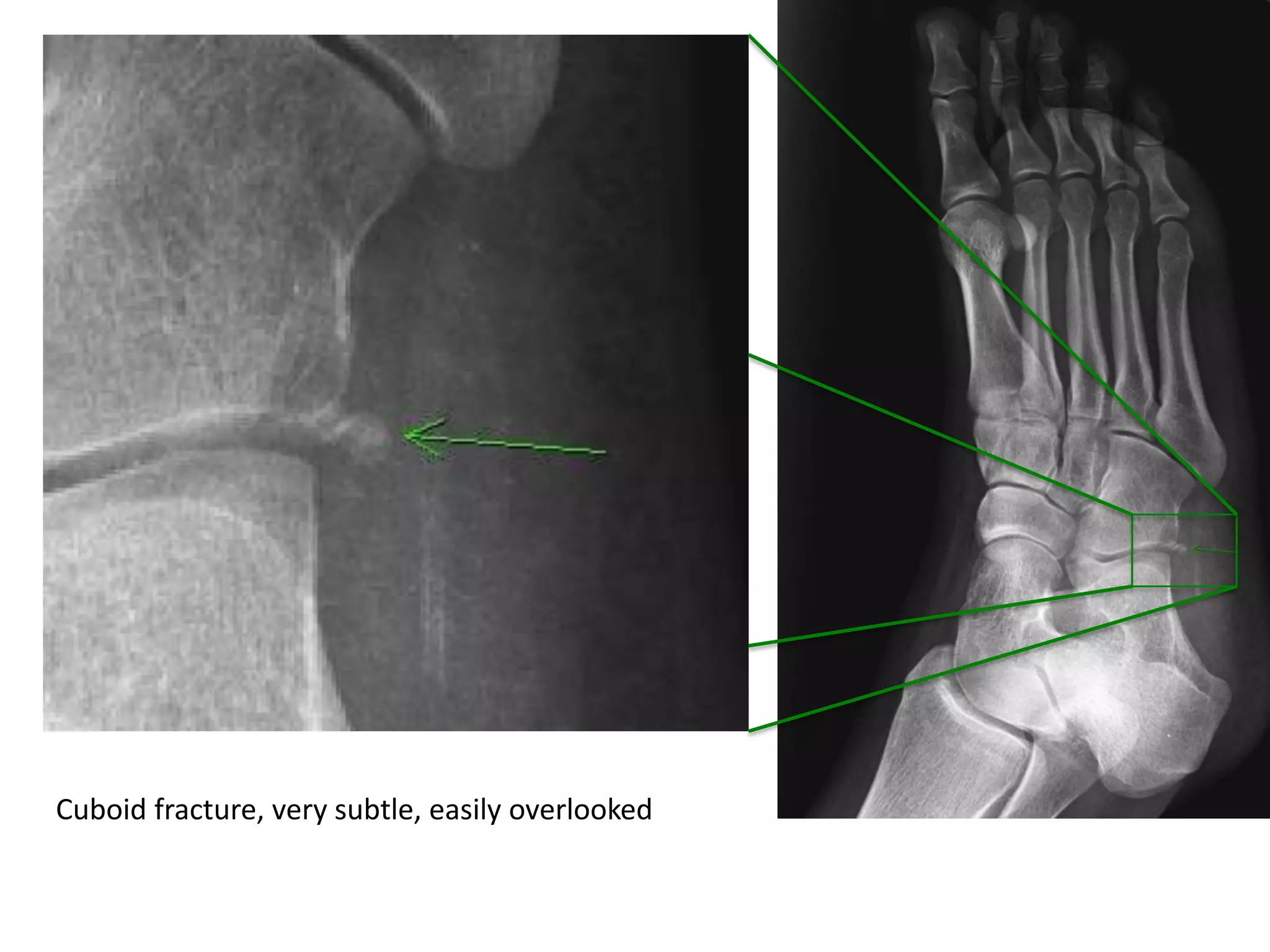 Foot fractures | PPTX