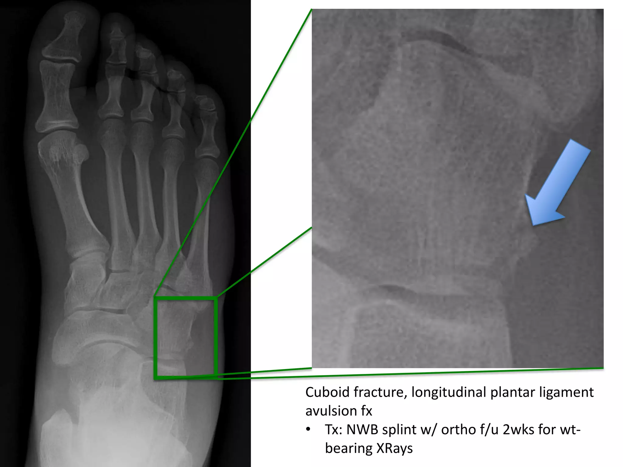 Foot fractures | PPTX