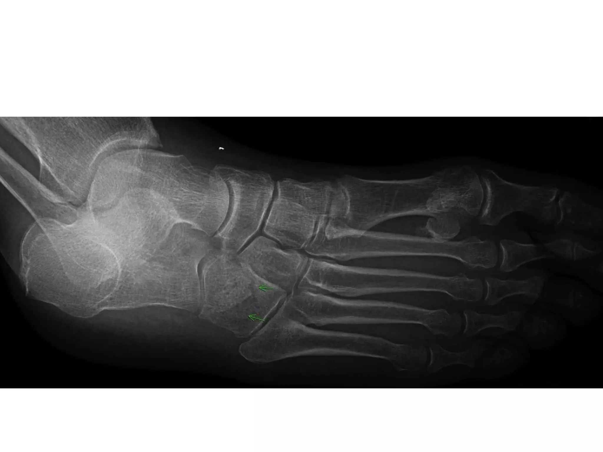 Foot fractures | PPTX