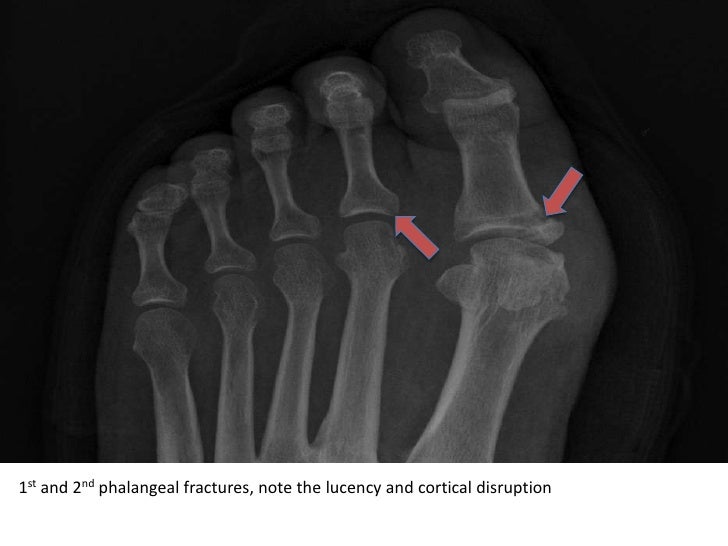 Midfoot fracture - merykorean
