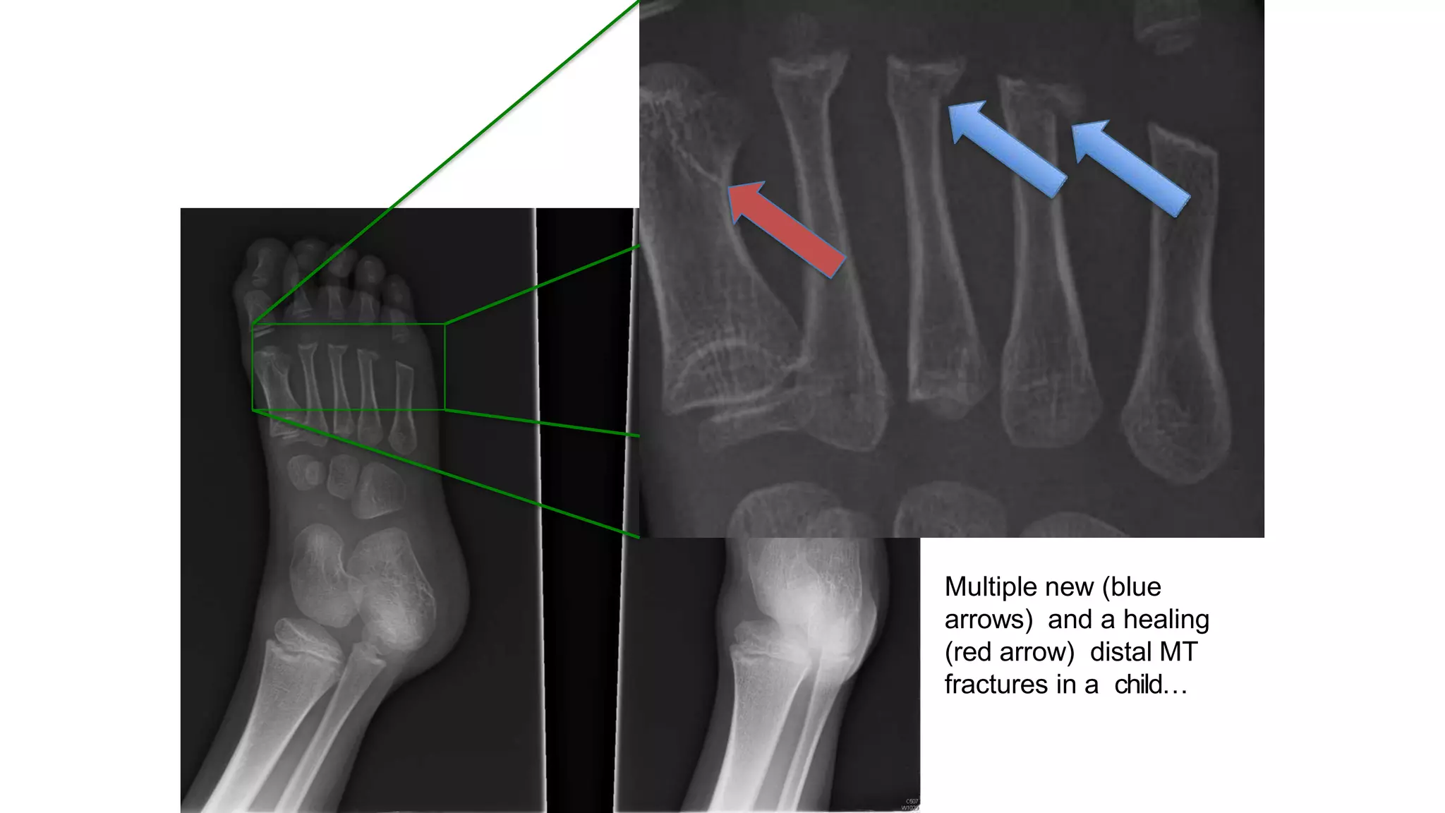 Foot fractures -meta tarsal fractures | PPTX