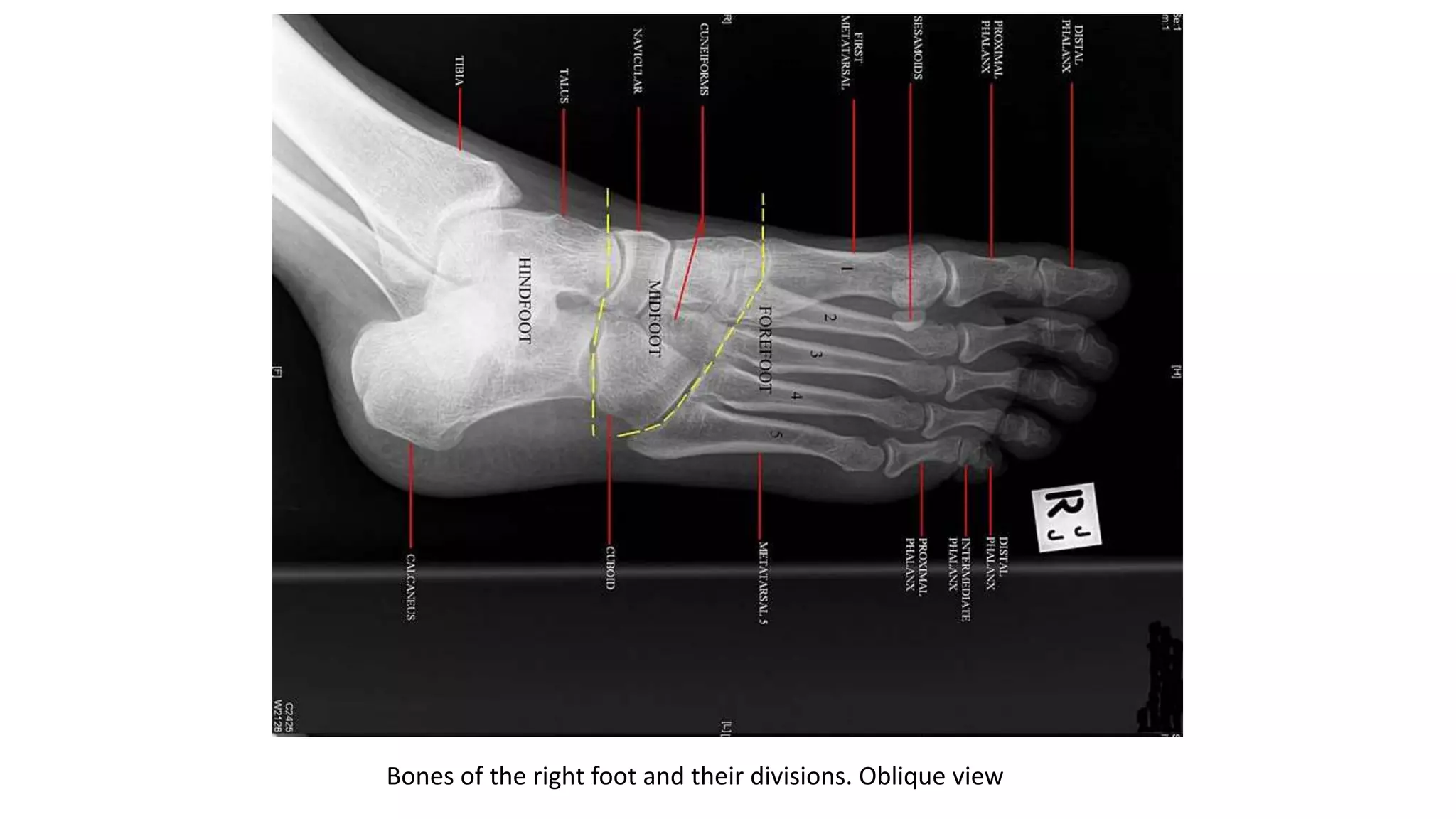 Foot fractures -meta tarsal fractures | PPTX