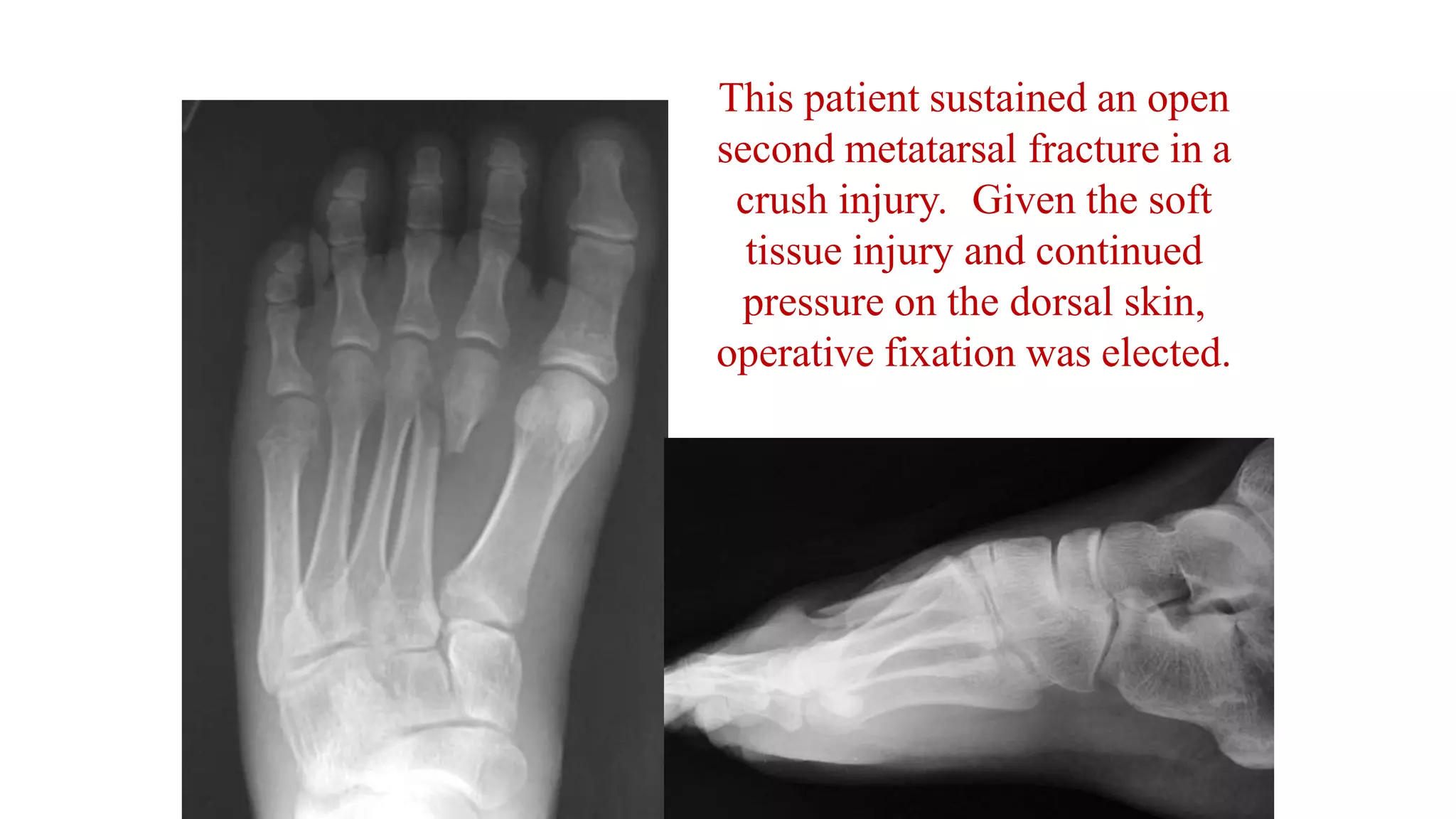 Foot fractures -meta tarsal fractures | PPTX