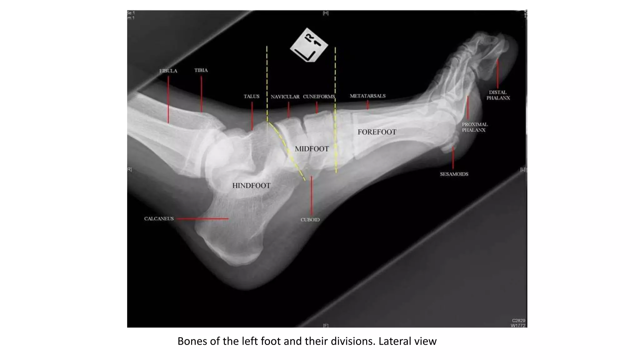Foot fractures -meta tarsal fractures | PPTX