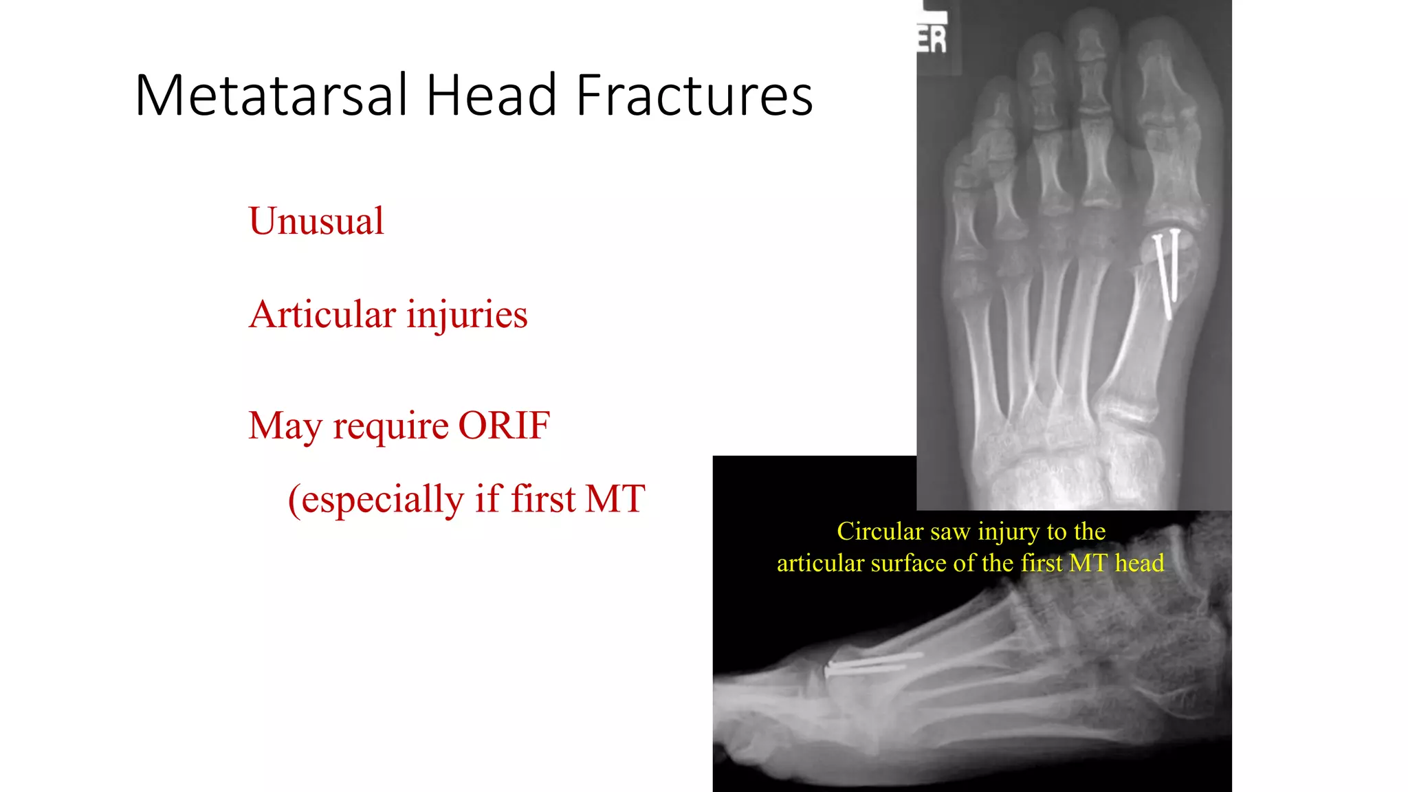 Foot fractures -meta tarsal fractures | PPTX