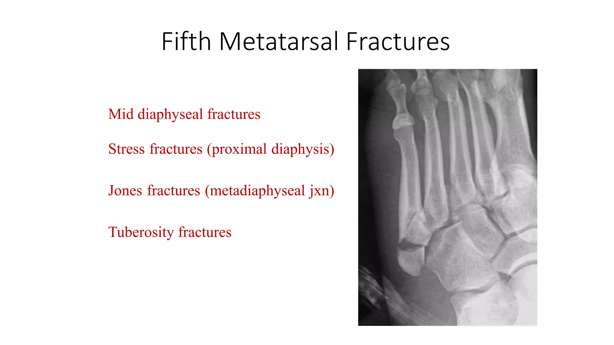 Foot fractures -meta tarsal fractures | PPTX