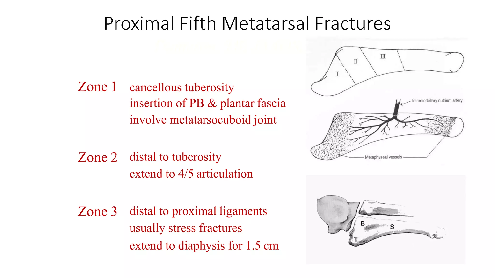 Foot fractures -meta tarsal fractures | PPTX