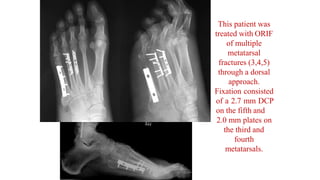 Foot fractures -meta tarsal fractures | PPTX