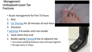 Foot fractures -meta tarsal fractures | PPTX