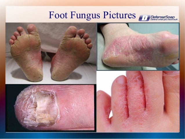 Foot Fungus in Athletes