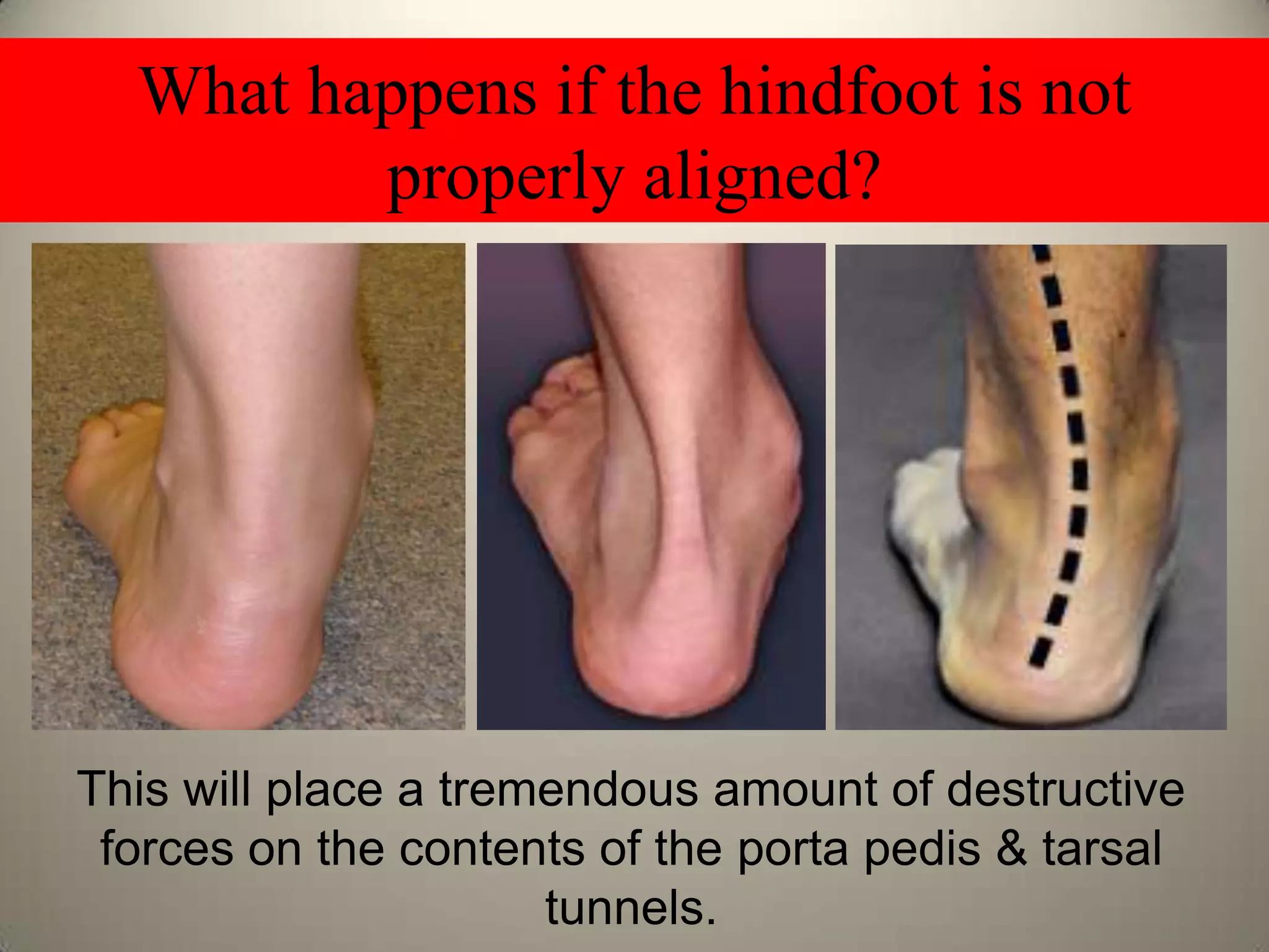 Peripheral Nerve Compression - Neuropathy | PPT