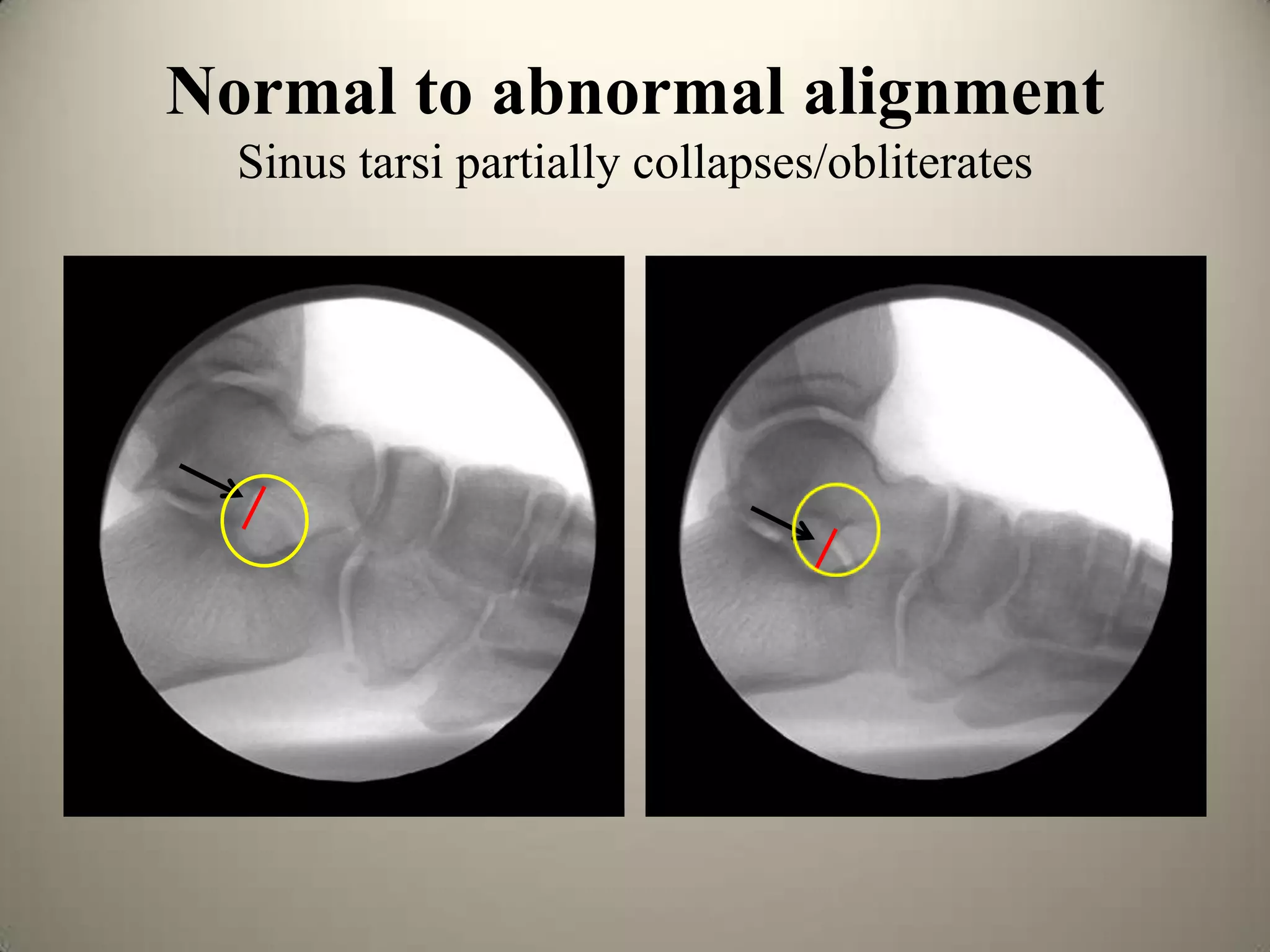 Peripheral Nerve Compression - Neuropathy | PPT