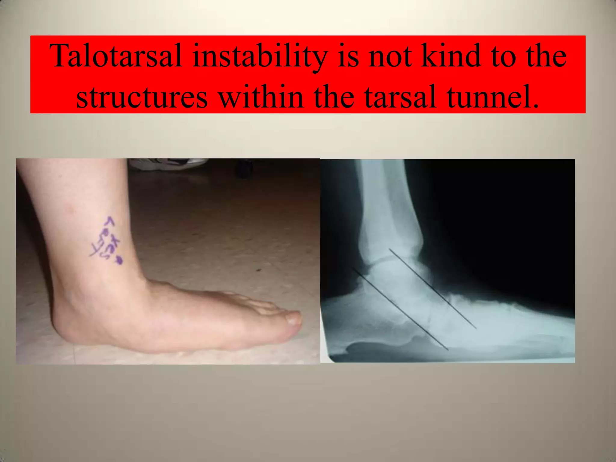 Peripheral Nerve Compression - Neuropathy | PPT