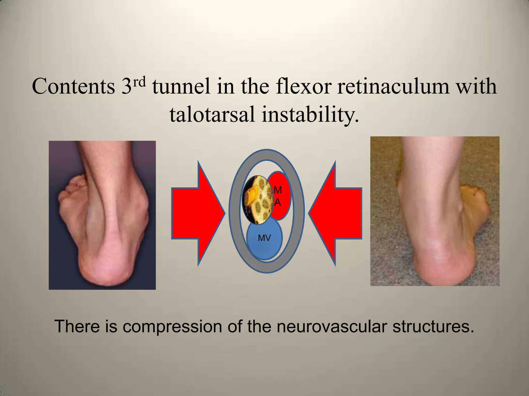 Peripheral Nerve Compression - Neuropathy | PPT