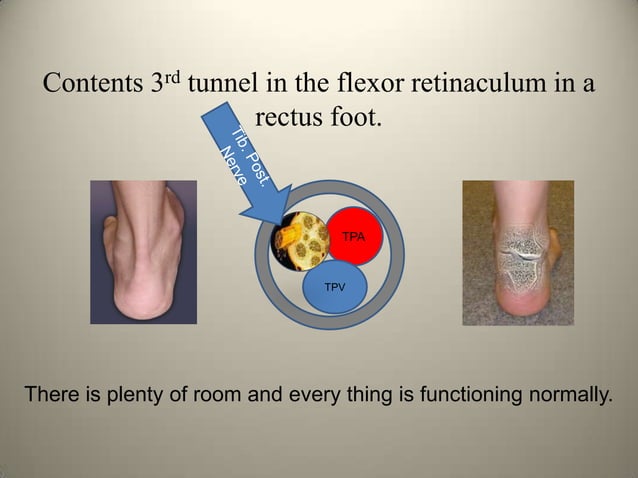 Peripheral Nerve Compression - Neuropathy | PPT