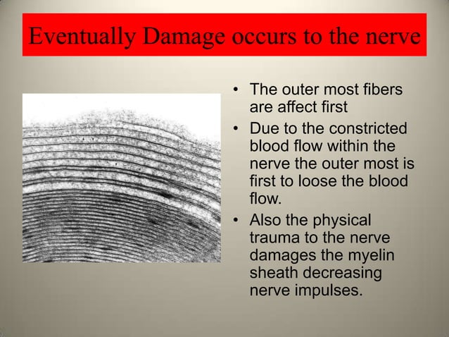 Peripheral Nerve Compression - Neuropathy | PPT