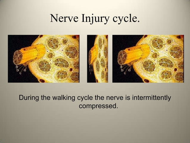 Peripheral Nerve Compression - Neuropathy | PPT