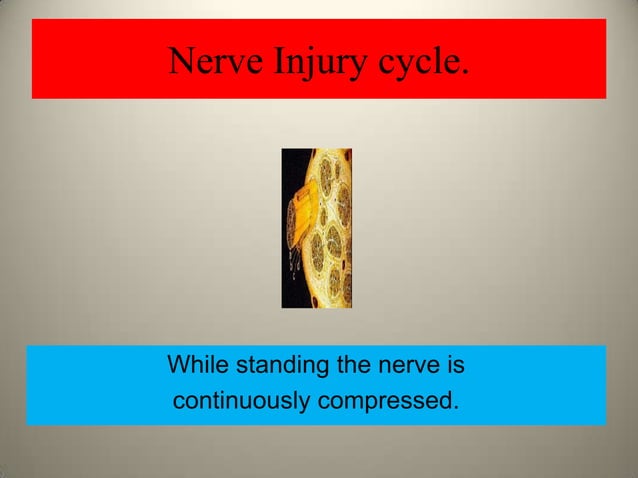 Peripheral Nerve Compression - Neuropathy | PPT