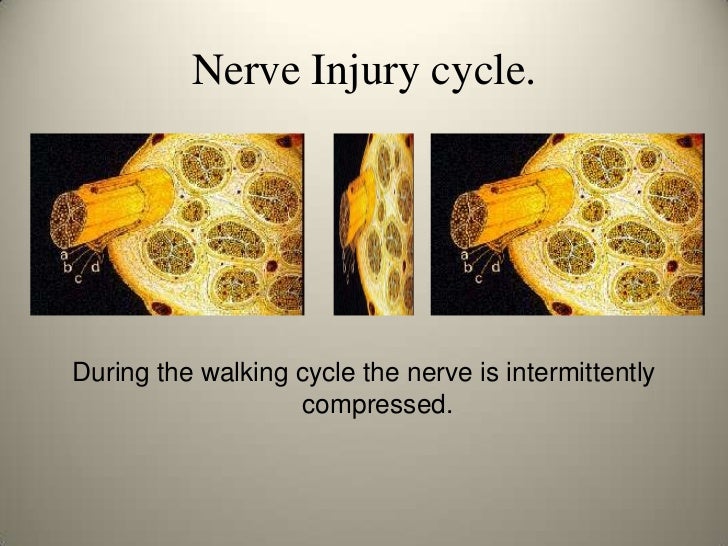 Peripheral Nerve Compression - Neuropathy