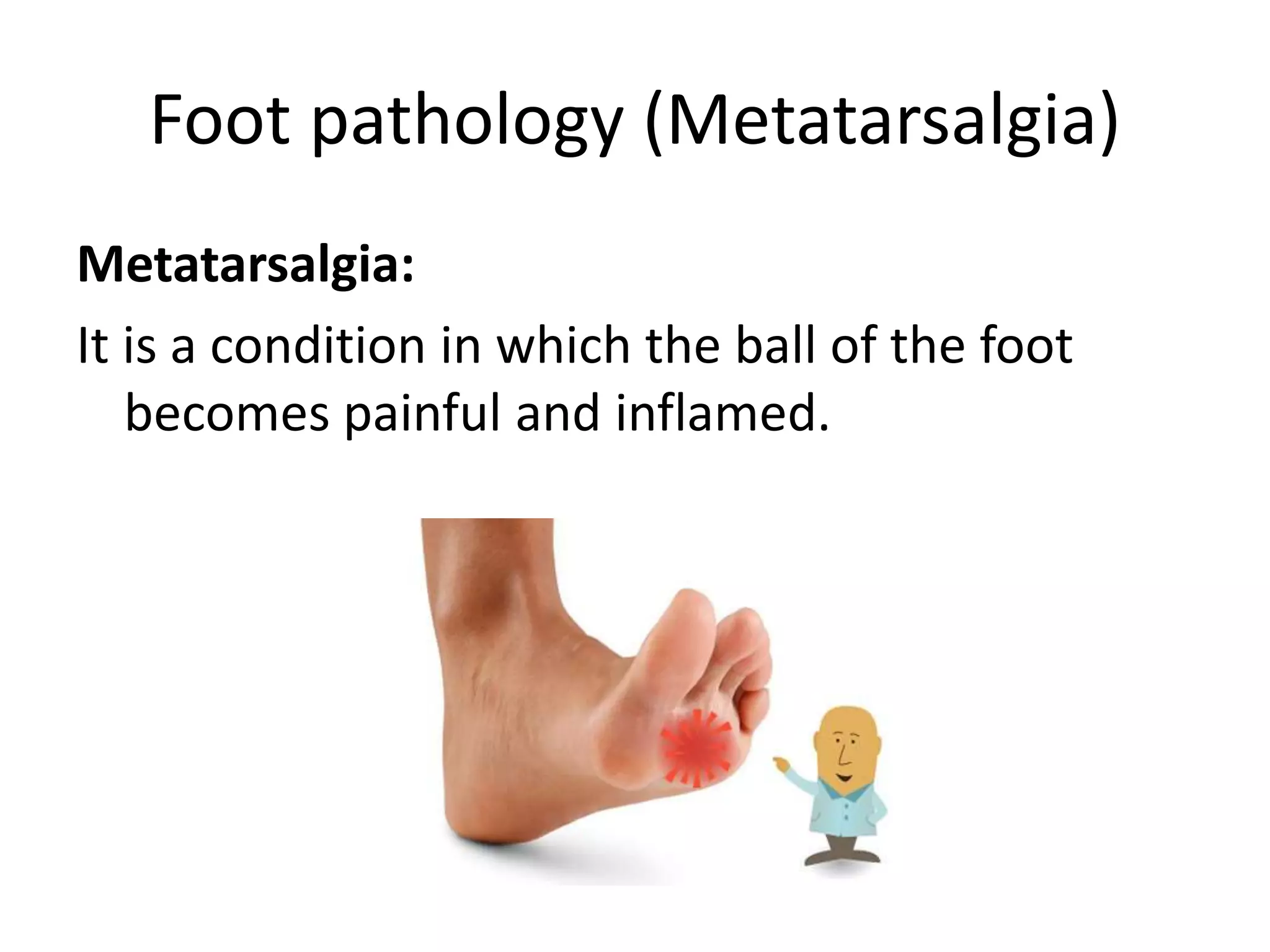 Foot pathology(metatarsalgia) | PPTX