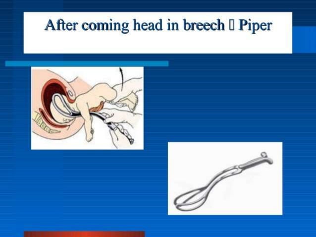Forcep delivery | PPTX | Pregnancy | Reproductive Health
