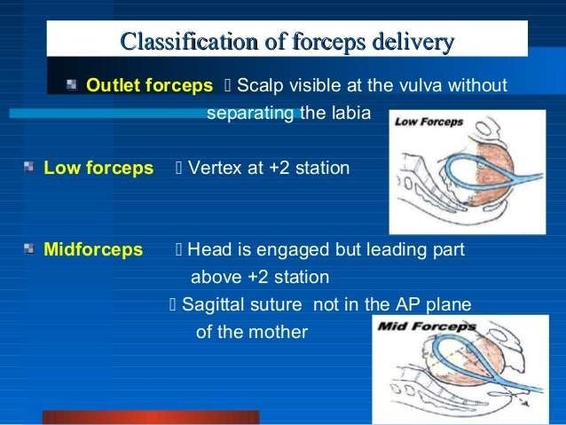 Forcep delivery
