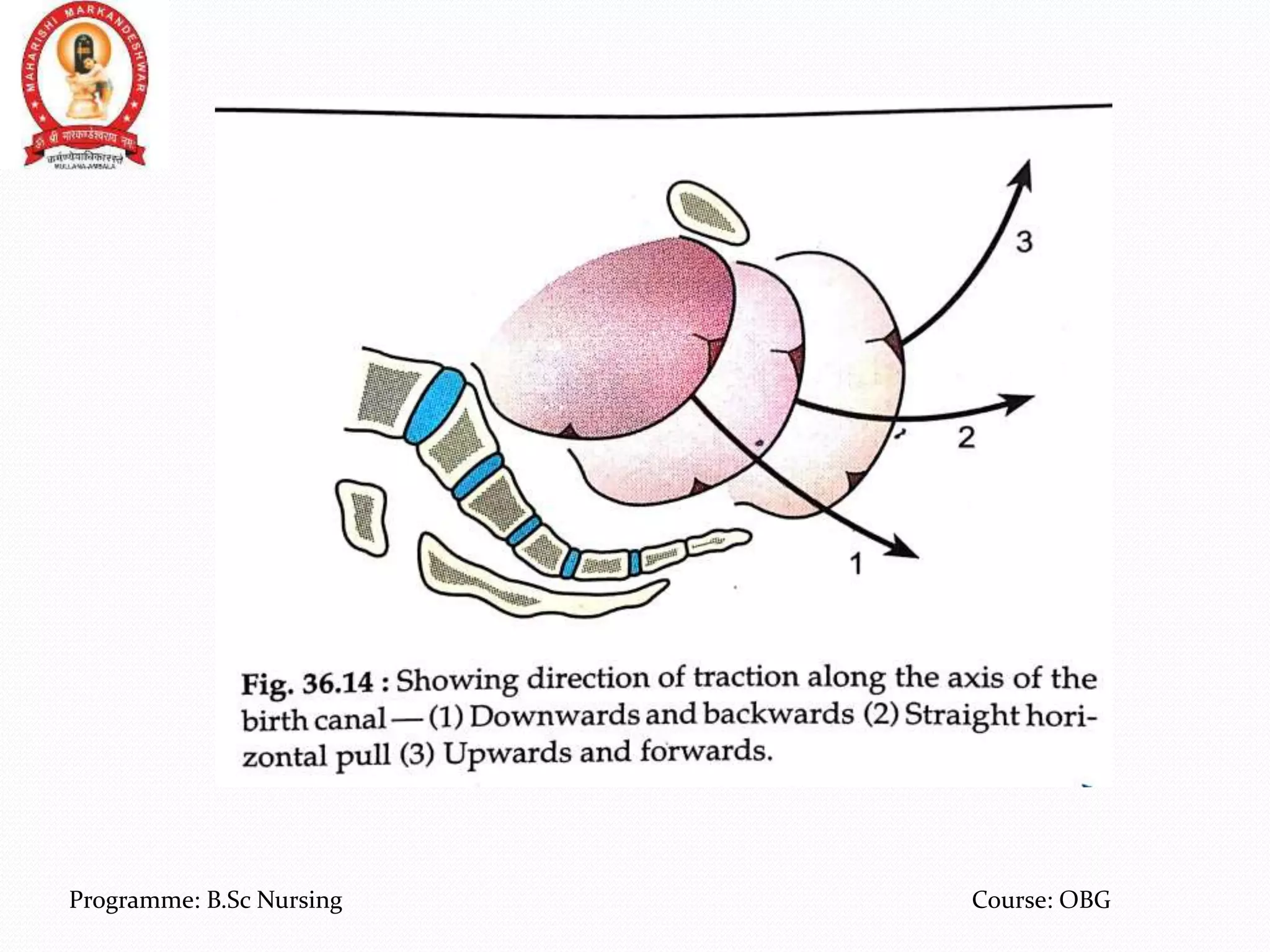 FORCEP DELIVERY.pptx