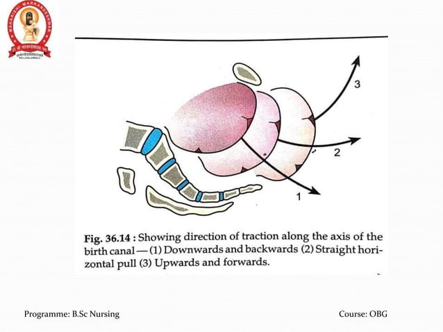 FORCEP DELIVERY.pptx