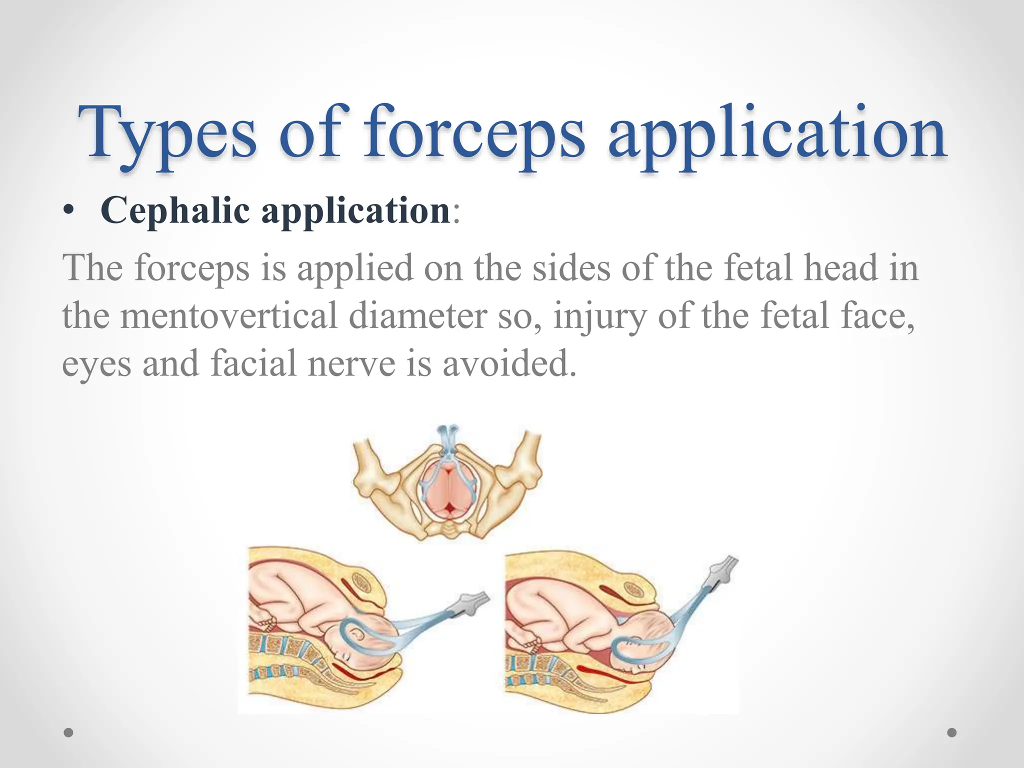 FORCEPS DELIVERY............ | PPTX