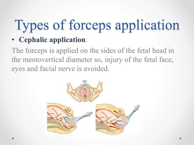FORCEPS DELIVERY............ | PPTX
