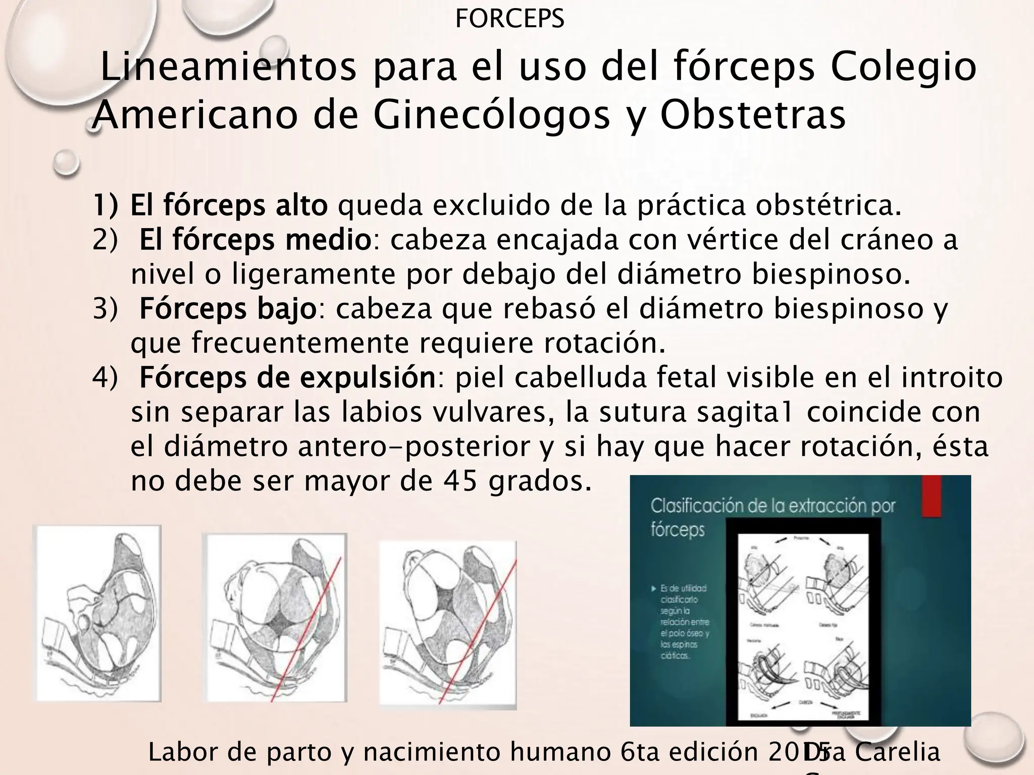 forceps utilizado en el trabajo de parto | PPTX