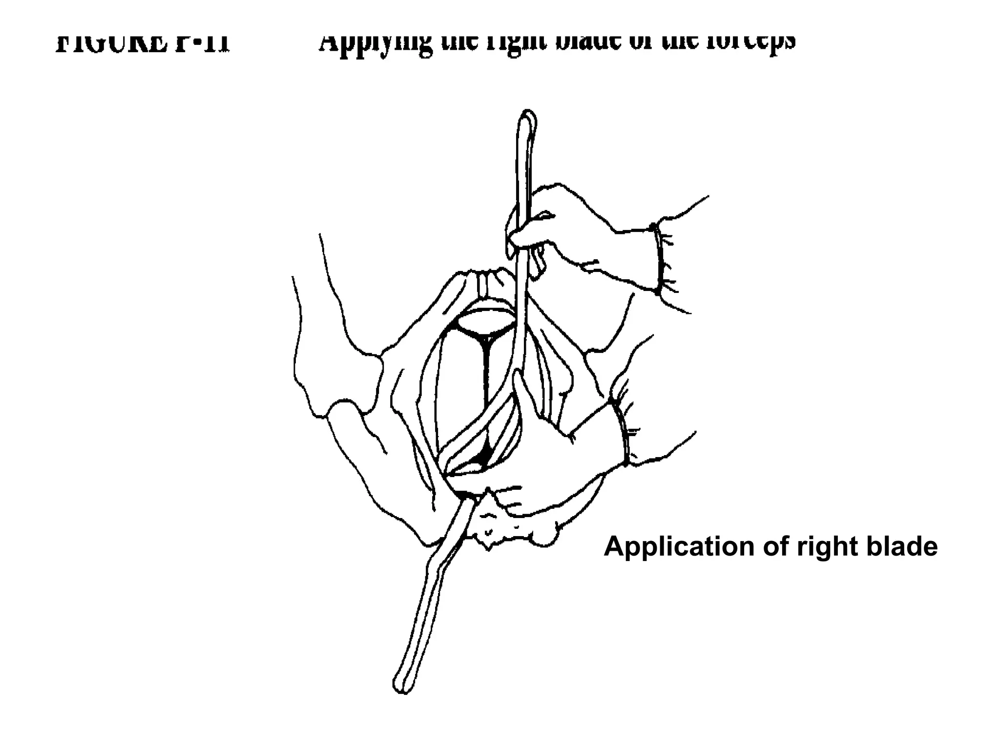 FORCEPS_DELIVERY_AND_VACCUM_EXTRACTION.ppt
