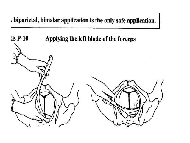 FORCEPS_DELIVERY_AND_VACCUM_EXTRACTION.ppt | Pregnancy | Reproductive ...