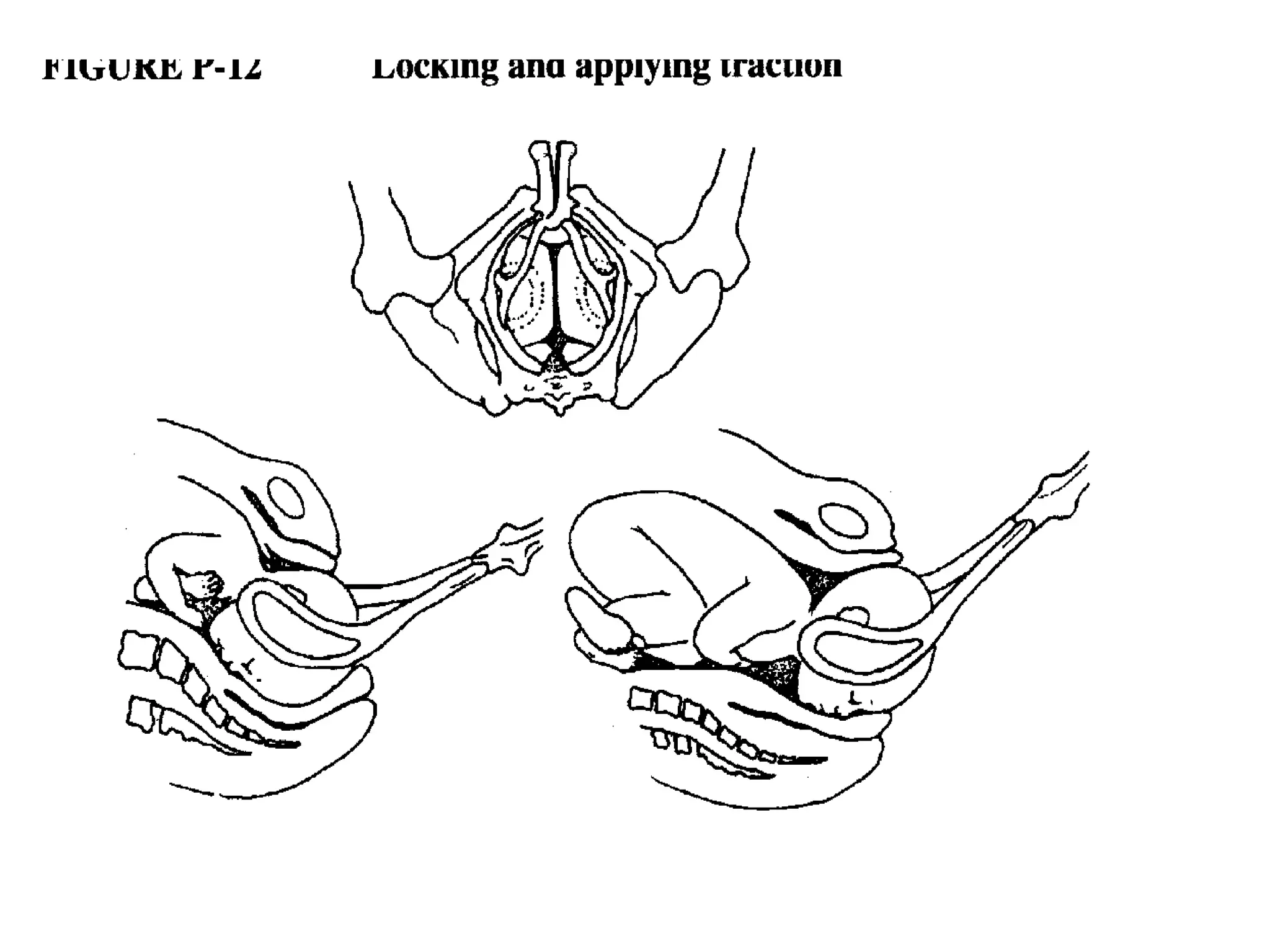 FORCEPS_DELIVERY_AND_VACCUM_EXTRACTION.ppt