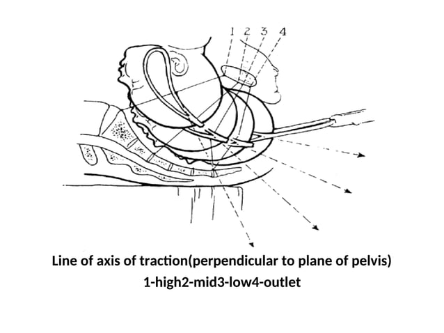 FORCEPS_DELIVERY_AND_VACCUM_EXTRACTION.ppt