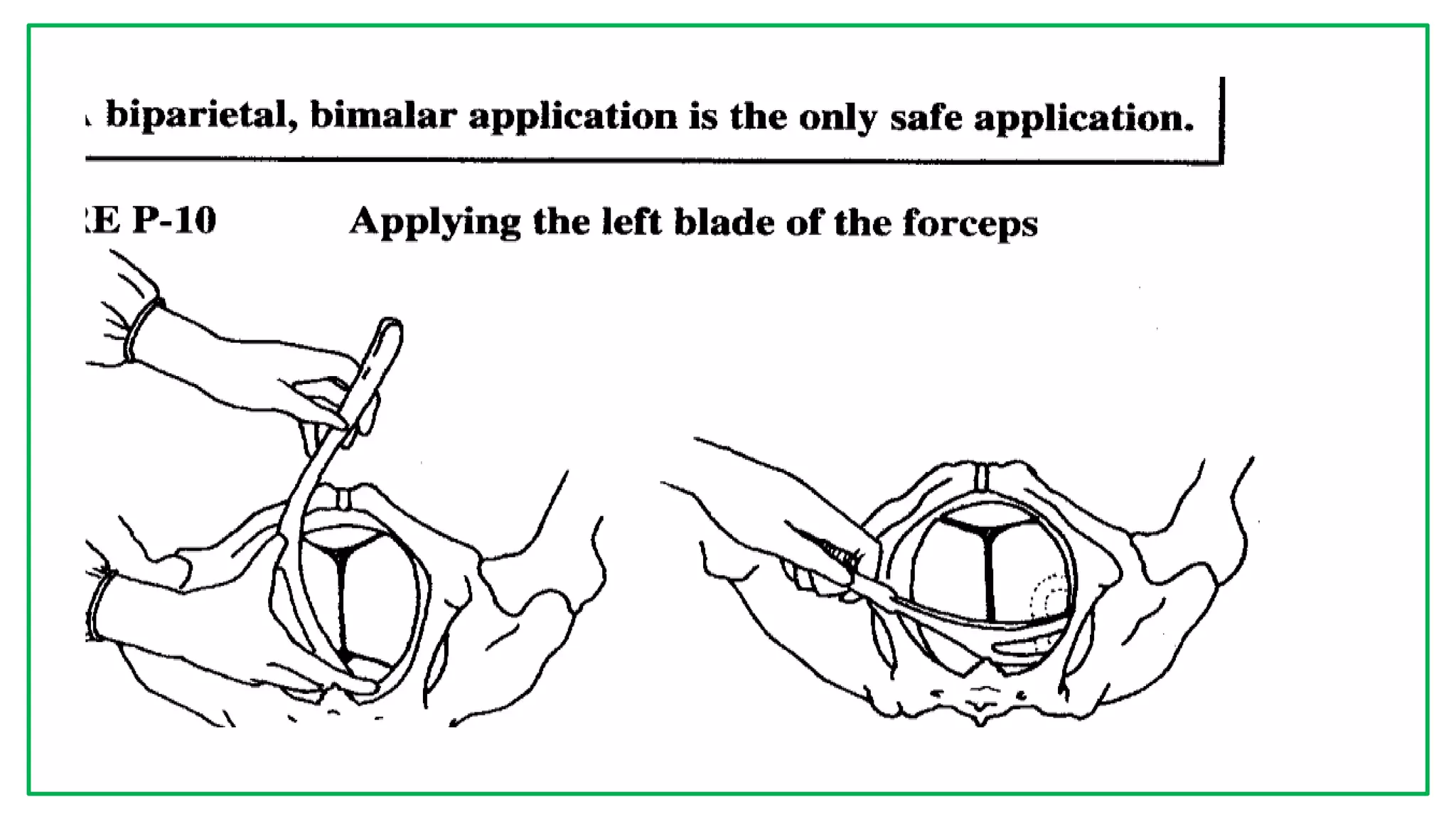 Forceps delivery and vacuum extraction | PPT | Pregnancy | Reproductive ...