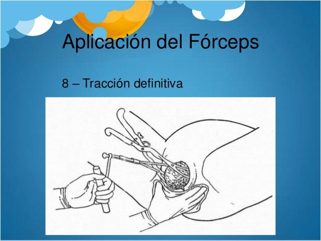 Forceps y cesarea